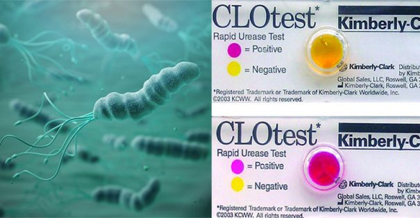 CLO Test Là Gì? Tất tần tật về Clo-Test trong Xét nghiệm HP