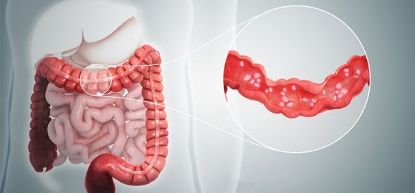 Viêm Đại Tràng Cấp Tính: Nhận Biết Sớm Dấu Hiệu Và Điều Trị Hiệu Quả